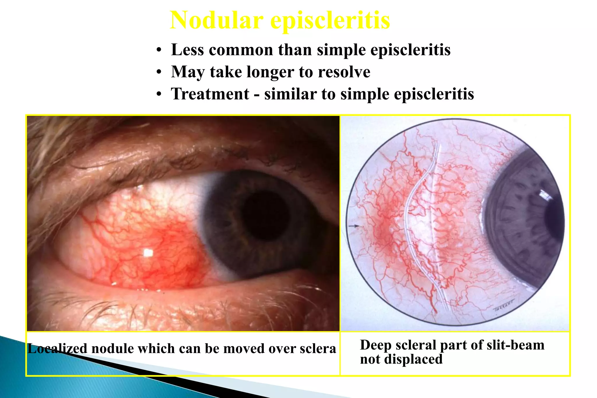 SCLERITIS | PPT