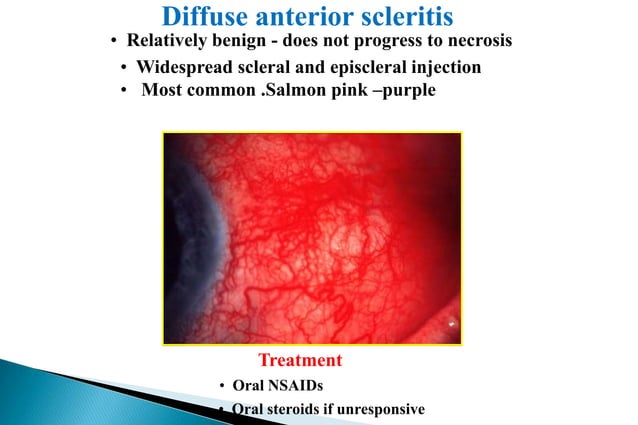 SCLERITIS | PPT