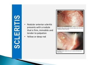 SCLERITIS | PPT