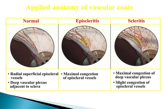 SCLERITIS | PPT