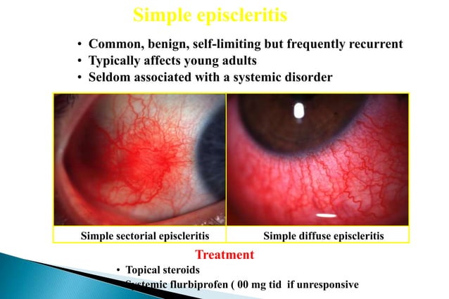 SCLERITIS | PPT