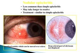 SCLERITIS | PPT