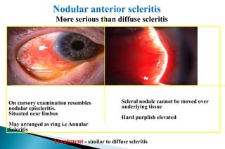 Diffuse Scleritis