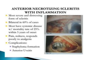 Necrotizing Scleritis With Inflammation