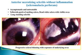 Necrotizing Scleritis With Inflammation