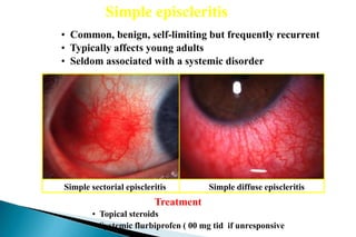 Diffuse Episcleritis