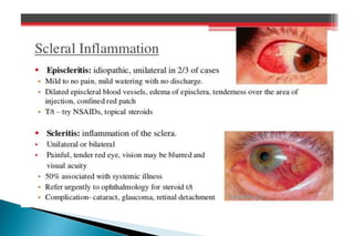 SCLERITIS | PPT