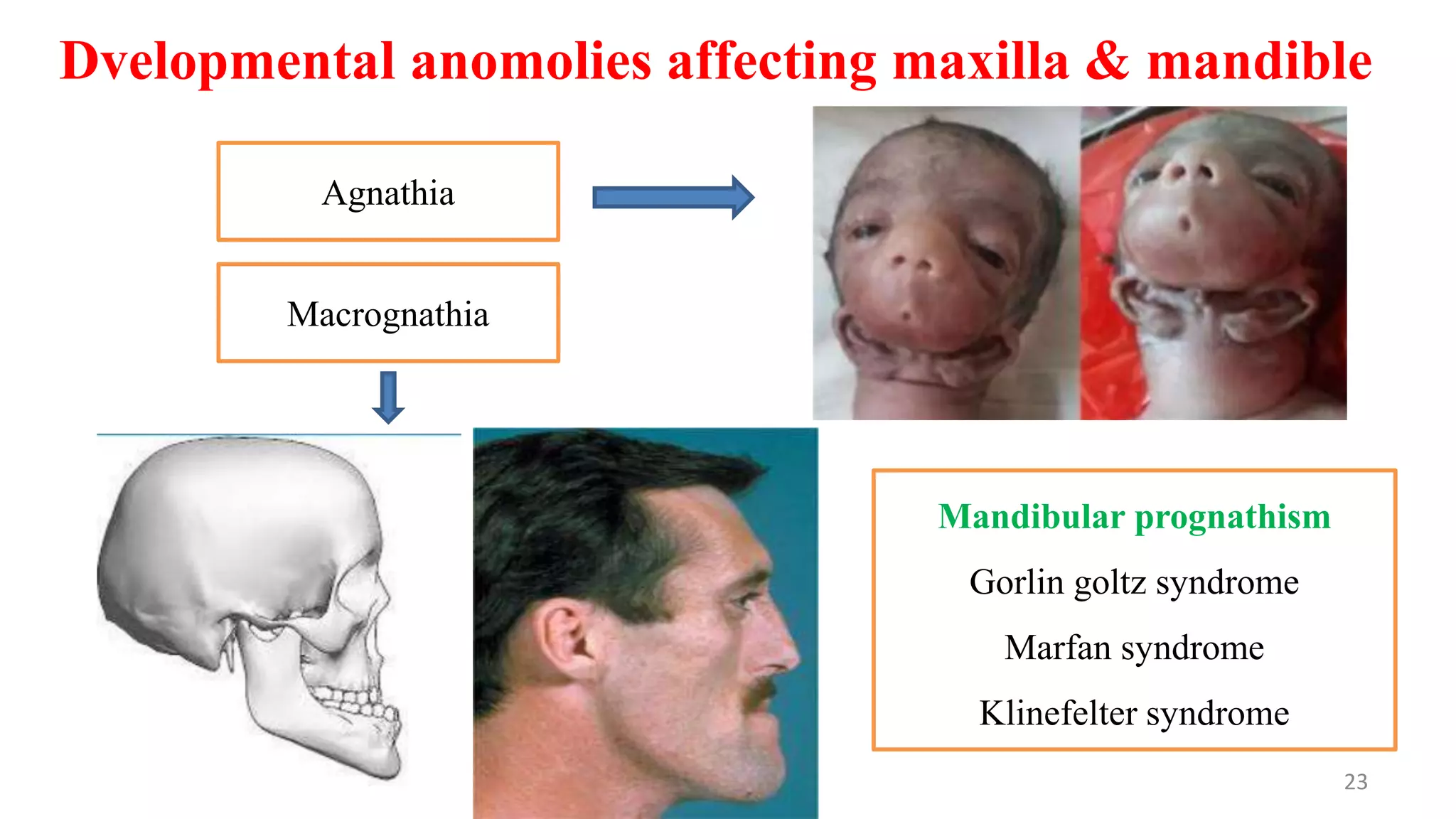 Postnatal growth of maxilla & mandible | PPTX