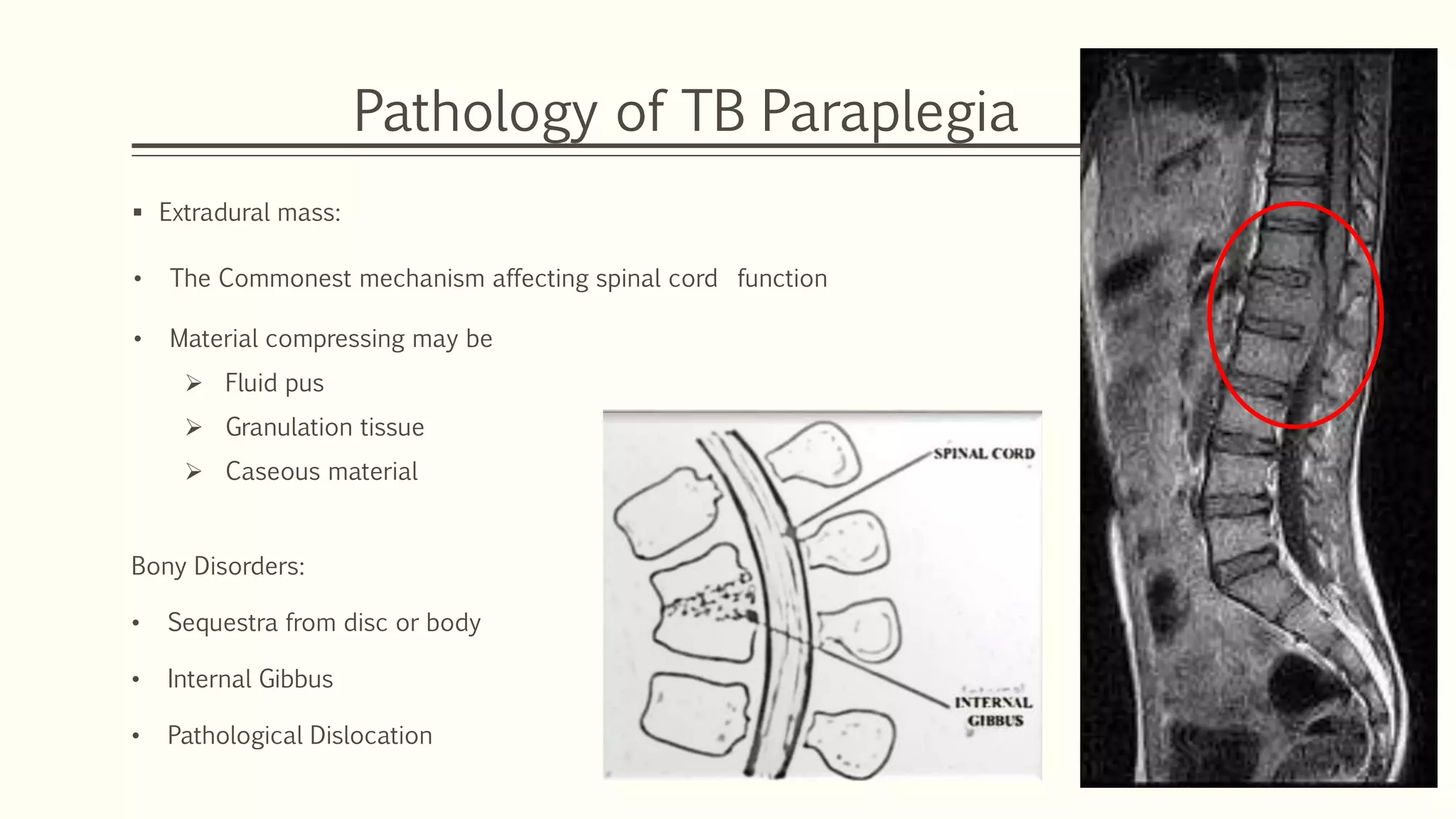 tuberculosis of the skeletal system | PPTX | Bone and Joint Conditions ...