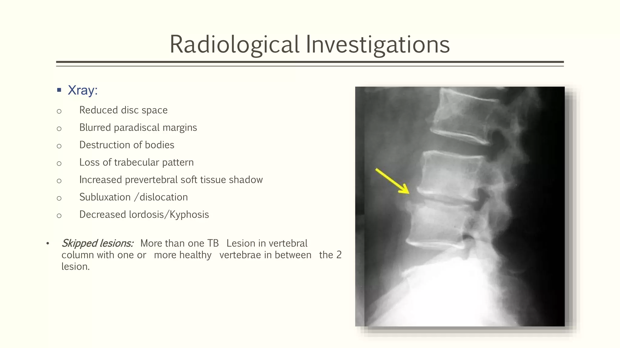 tuberculosis of the skeletal system | PPTX