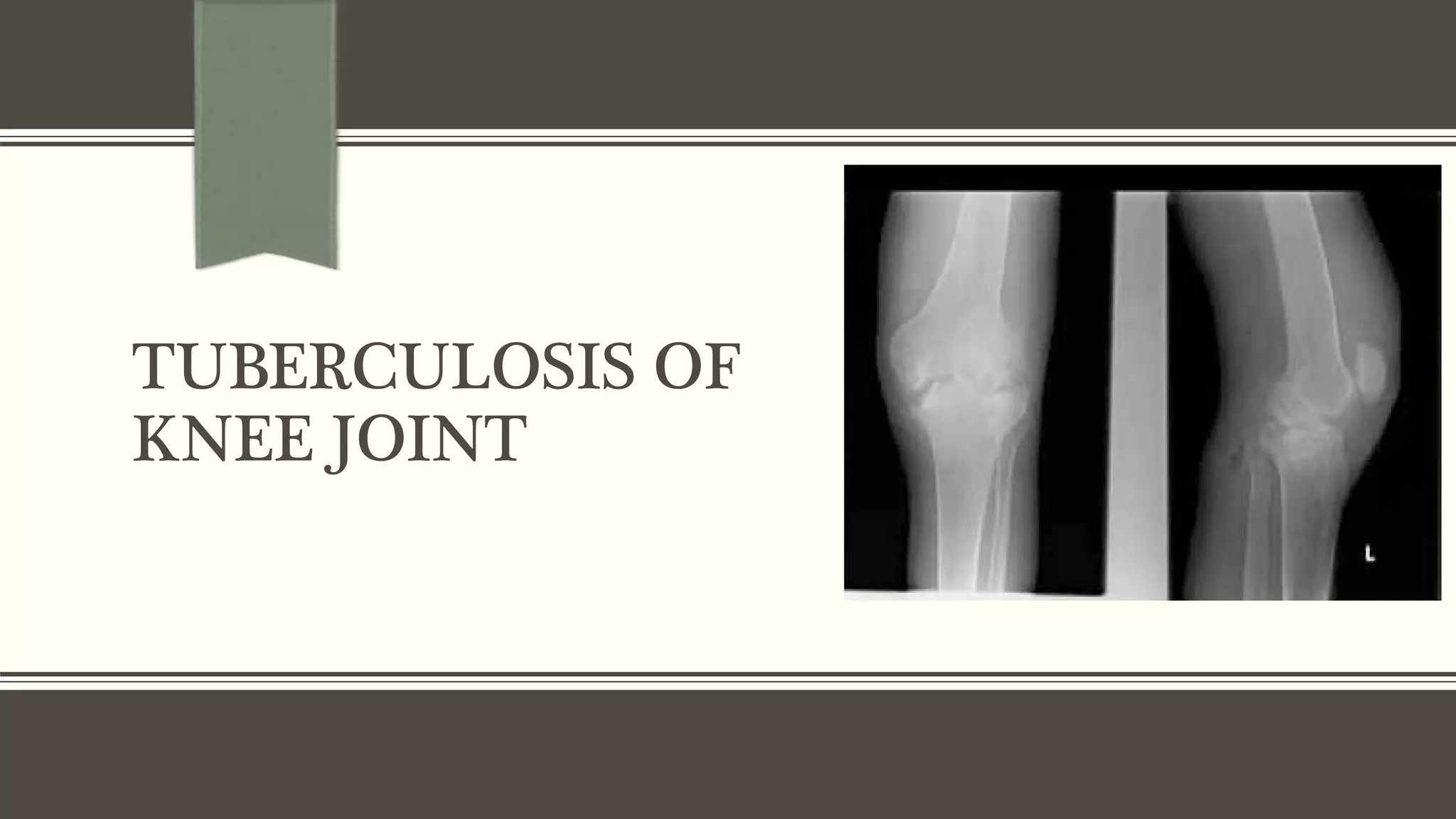 tuberculosis of the skeletal system | PPTX | Bone and Joint Conditions ...