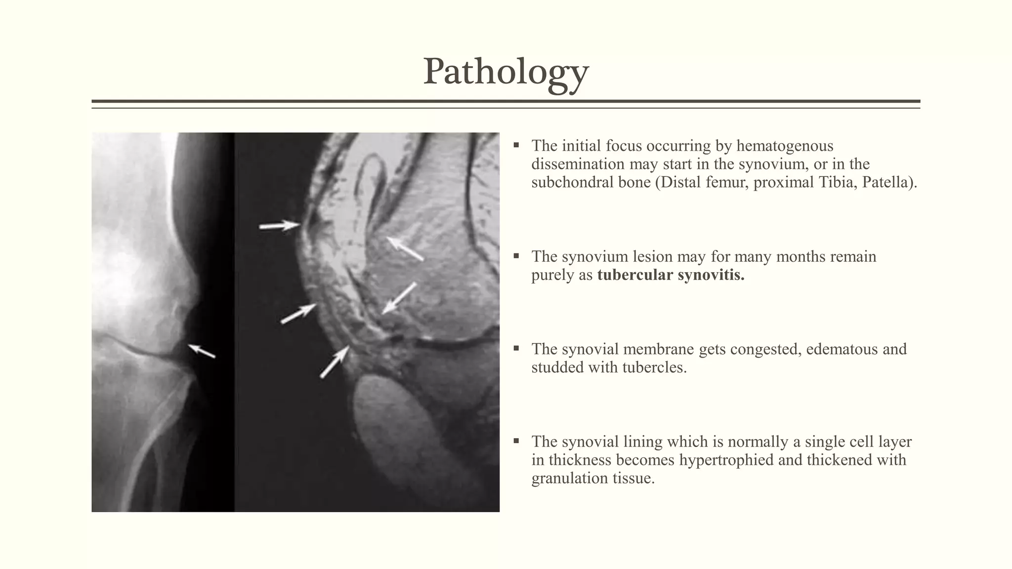 tuberculosis of the skeletal system | PPTX