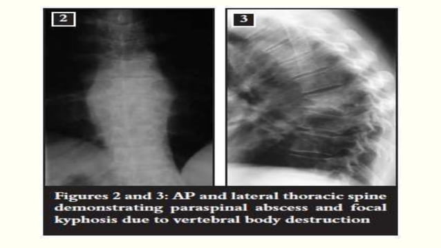 tuberculosis of the skeletal system | PPTX | Bone and Joint Conditions ...