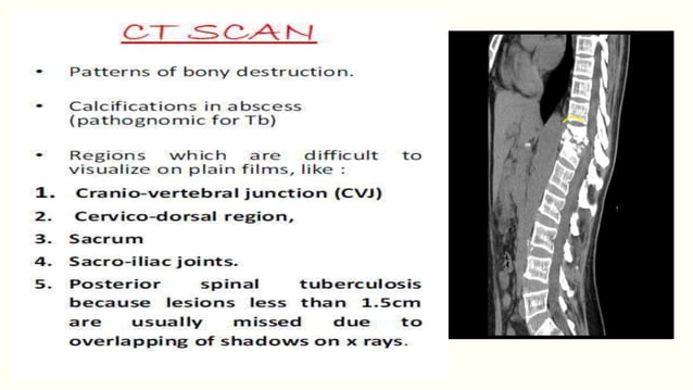 tuberculosis of the skeletal system | PPTX | Bone and Joint Conditions ...