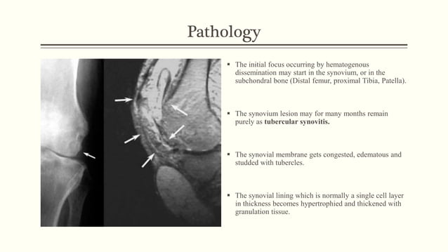 tuberculosis of the skeletal system | PPTX | Bone and Joint Conditions ...