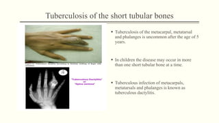 tuberculosis of the skeletal system | PPTX