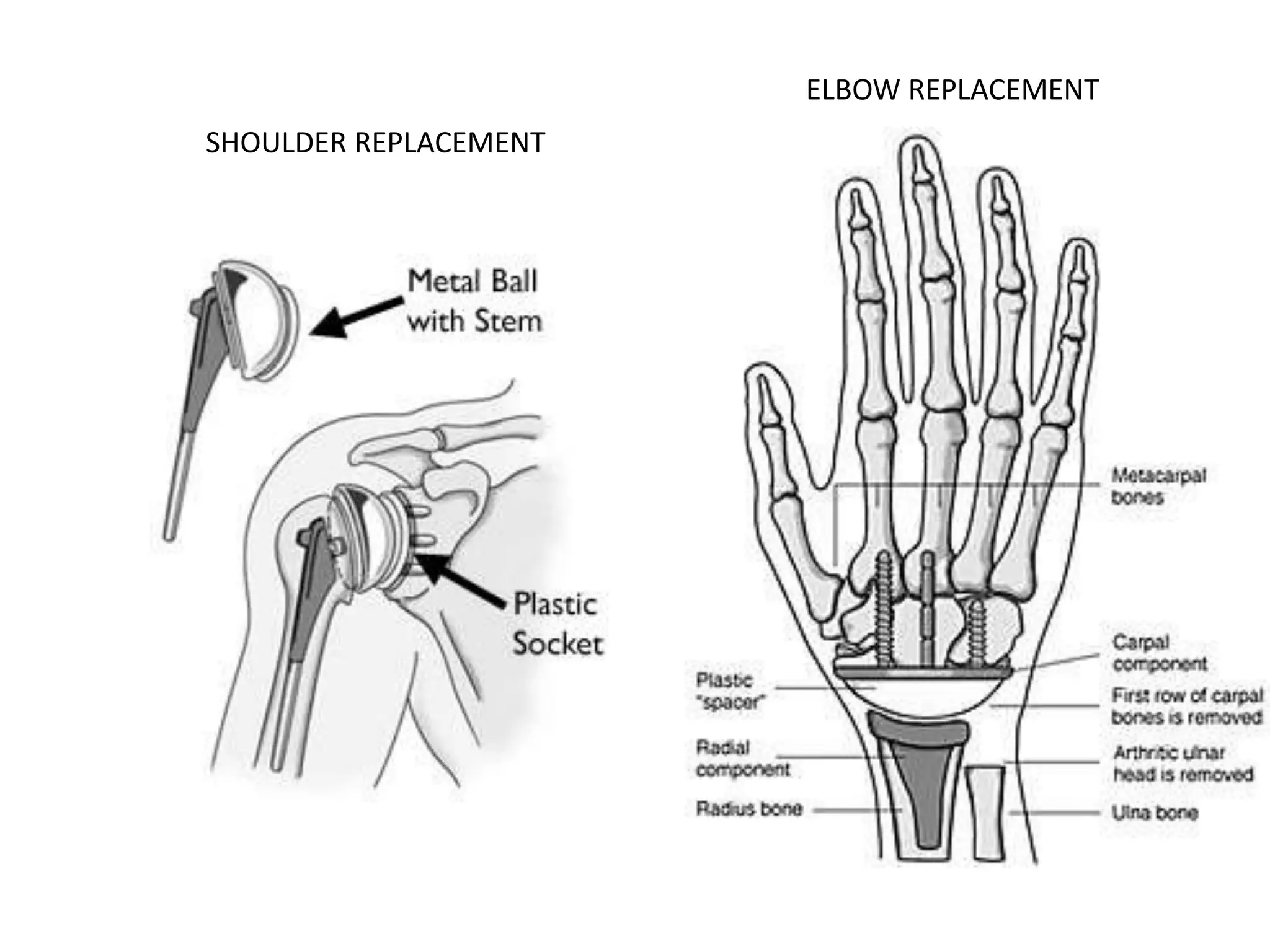 UHMWPE- Ultra high molecular weight polyethylene__as a biomaterial | PPTX