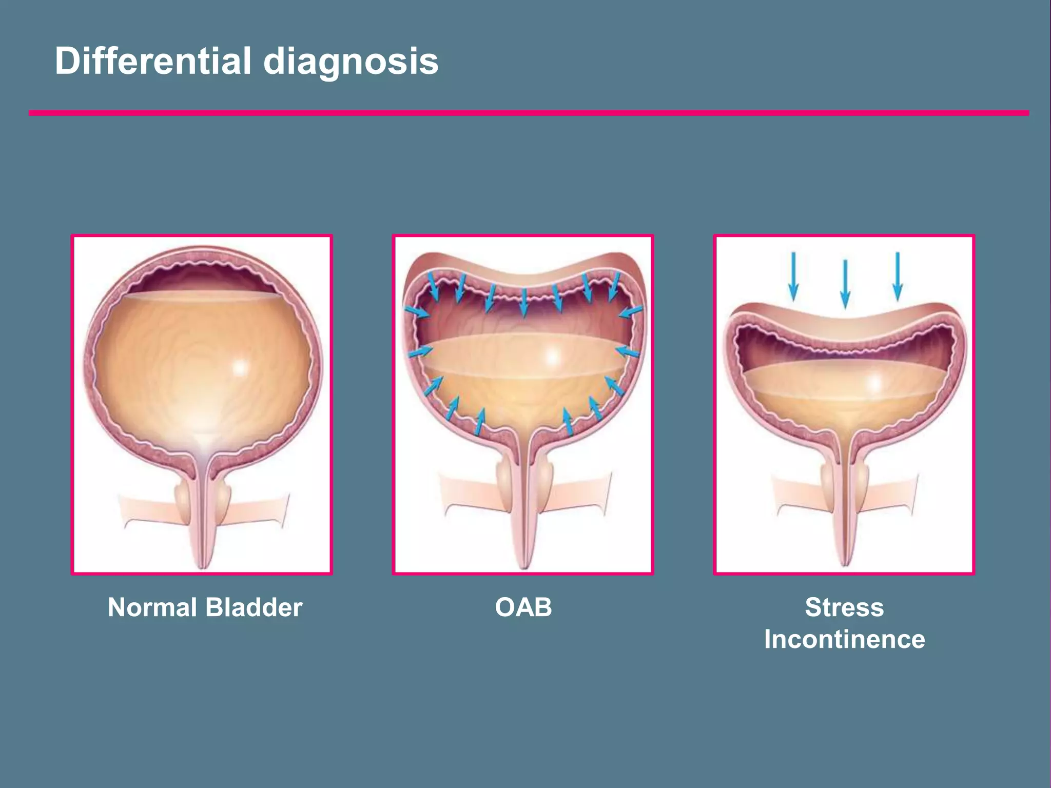 gynaecology,Urinary incontenince.(dr.hana) | PPTX
