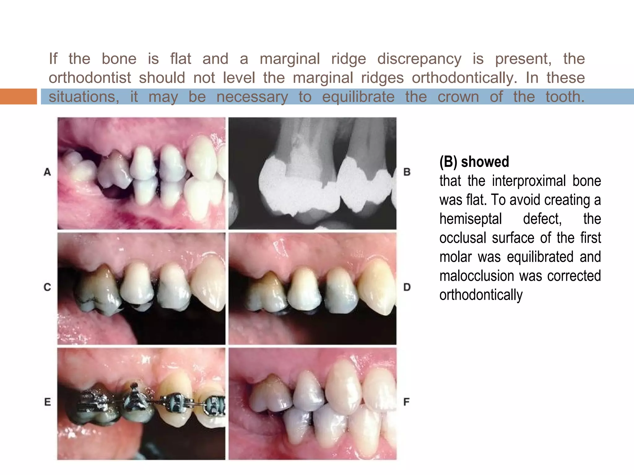Adjunctive role of Orthodontic Therapy in Periodontology | PPT