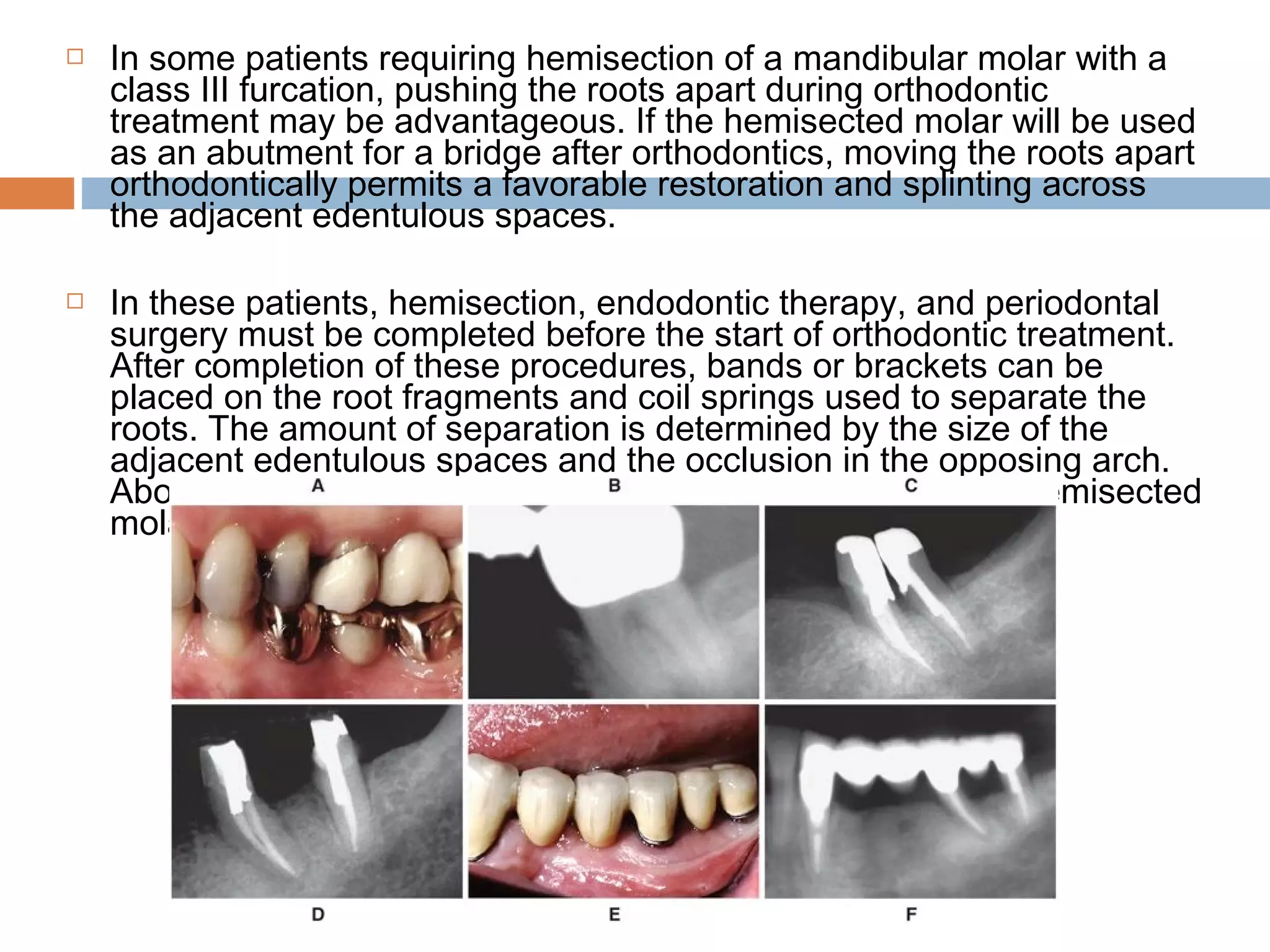Adjunctive role of Orthodontic Therapy in Periodontology | PPT