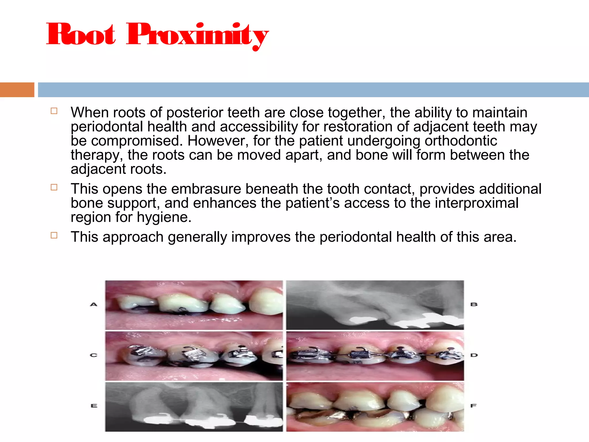 Adjunctive role of Orthodontic Therapy in Periodontology | PPT