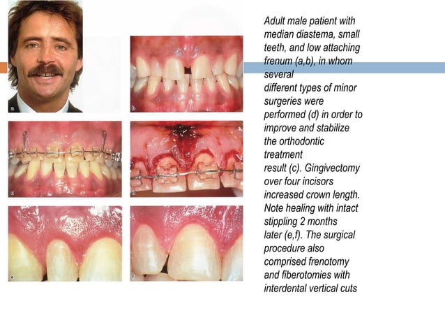 Adjunctive role of Orthodontic Therapy in Periodontology | PPT