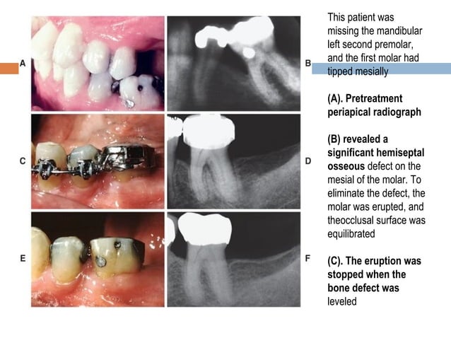 Adjunctive role of Orthodontic Therapy in Periodontology | PPT