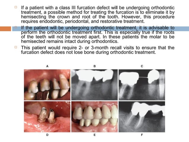 Adjunctive role of Orthodontic Therapy in Periodontology | PPT
