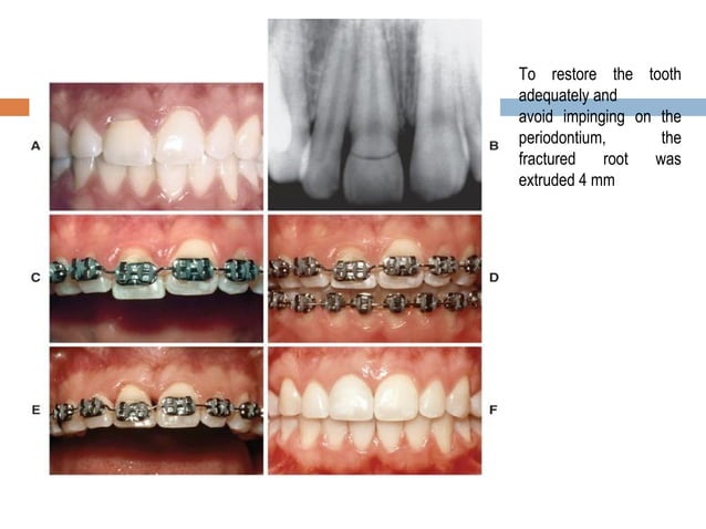 Adjunctive role of Orthodontic Therapy in Periodontology | PPT