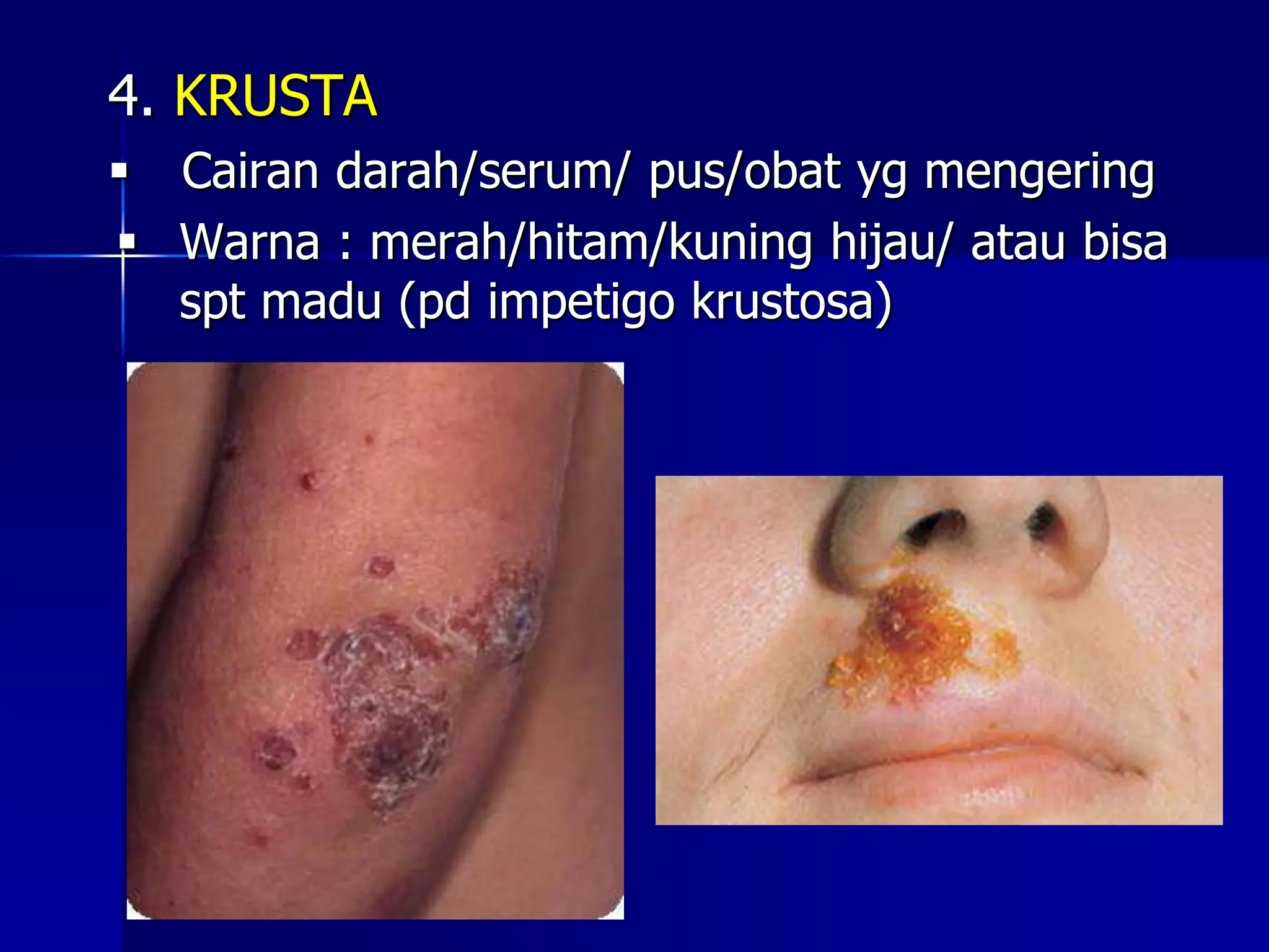 Ujud Kelainan Kulit.ppt