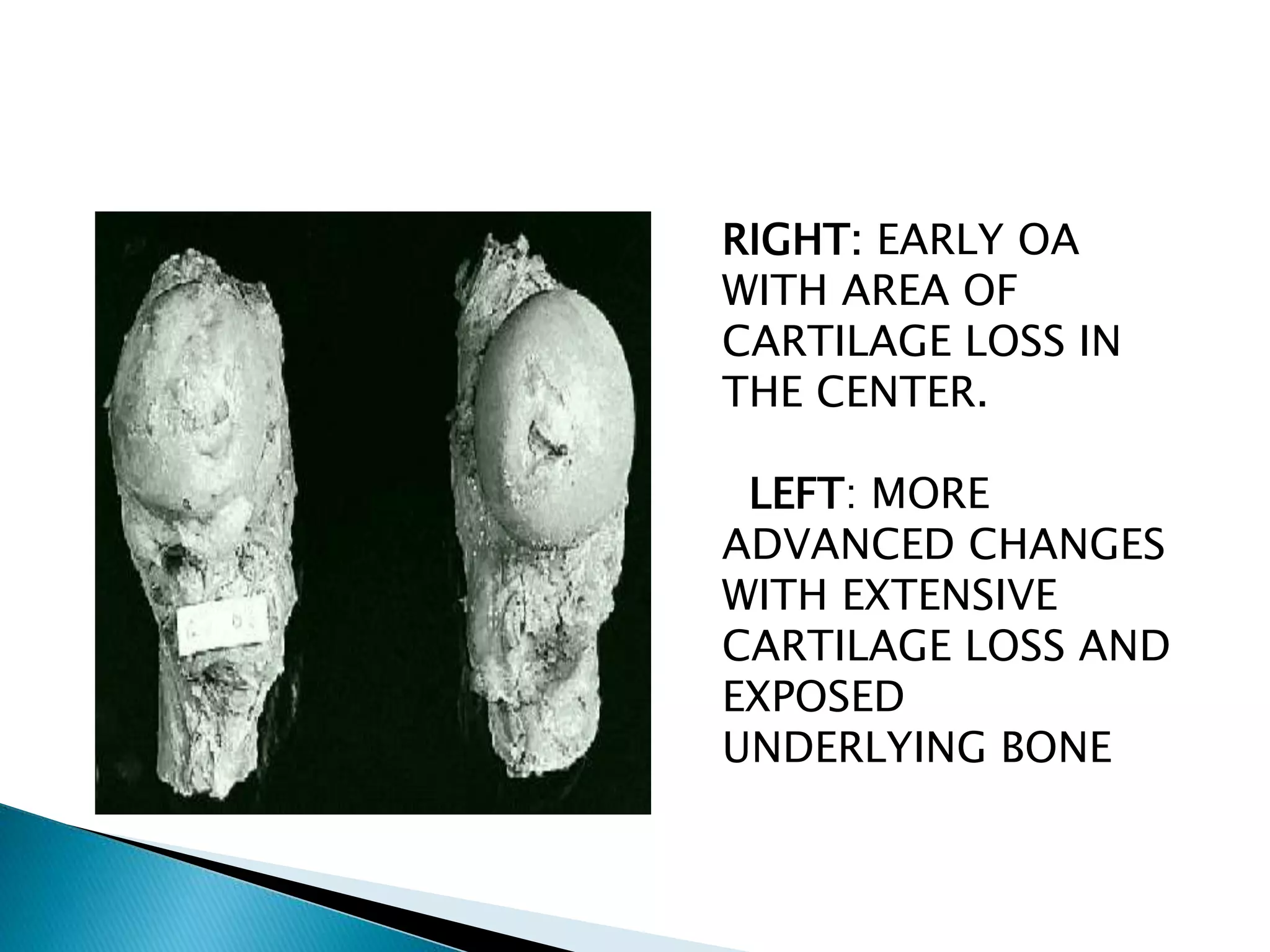 unilateral knee replacement vs high tibial osteotomy. | PPTX