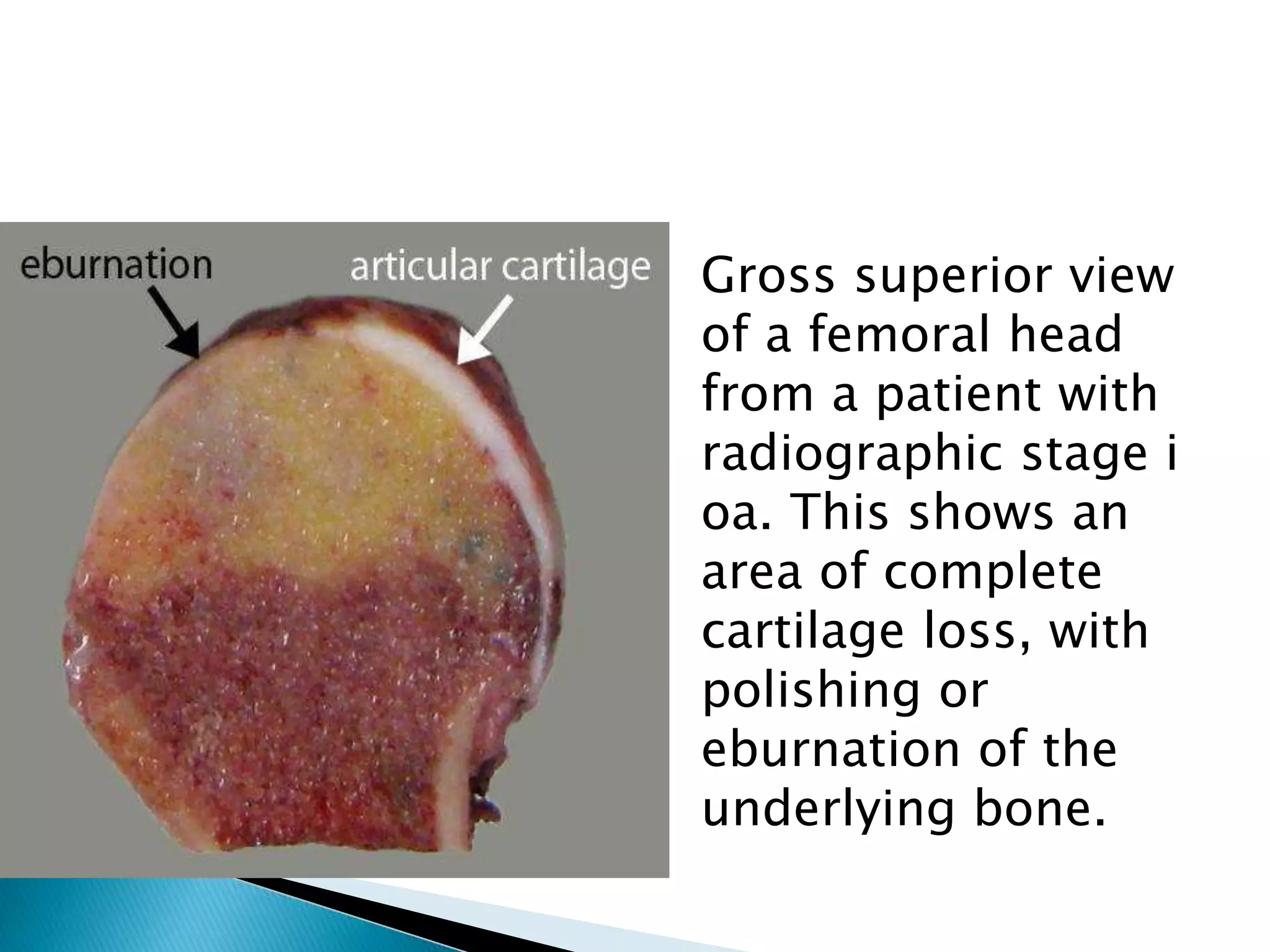 unilateral knee replacement vs high tibial osteotomy. | PPTX