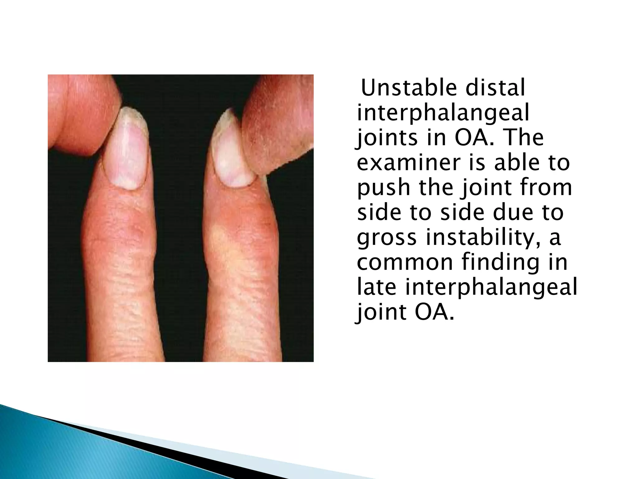 unilateral knee replacement vs high tibial osteotomy. | PPTX