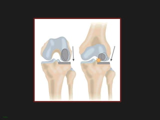 Unicompartmental Total knee replacement | PPTX