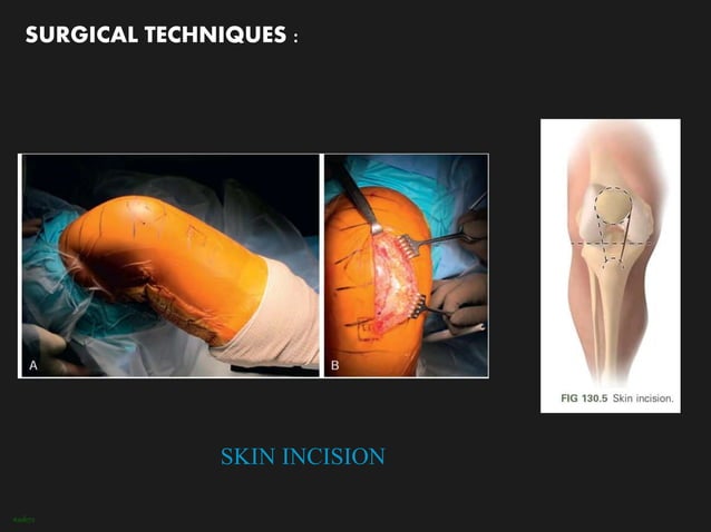 Unicompartmental Total knee replacement | PPTX | Death, Injury, or ...