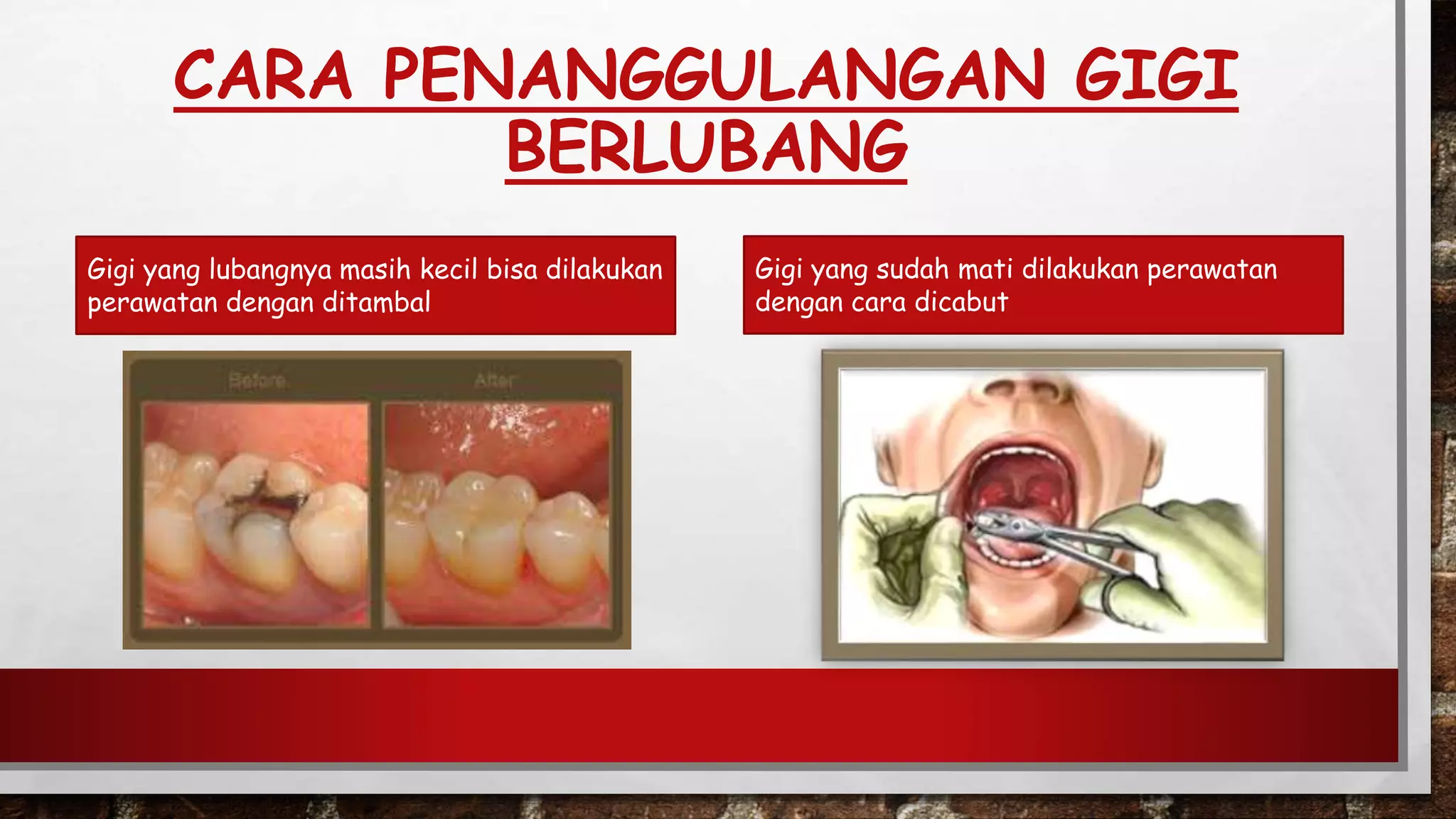 UKS penyuluhan Gigi berlubang karies.pptx