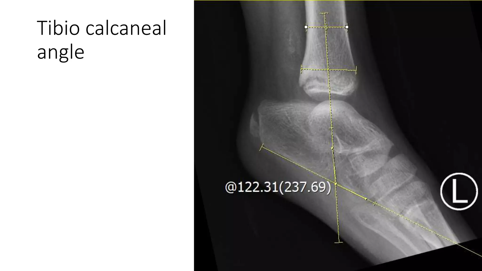 ukuran equinus deformity.pptx