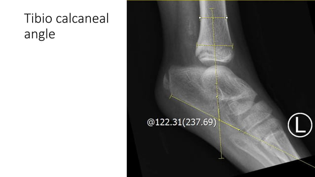 ukuran equinus deformity.pptx