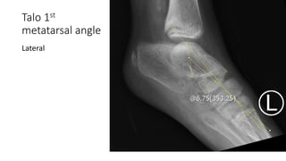 ukuran equinus deformity.pptx