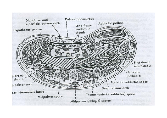 UL-fascial spaces in palm upper limb topic in anatomy (1).pdf