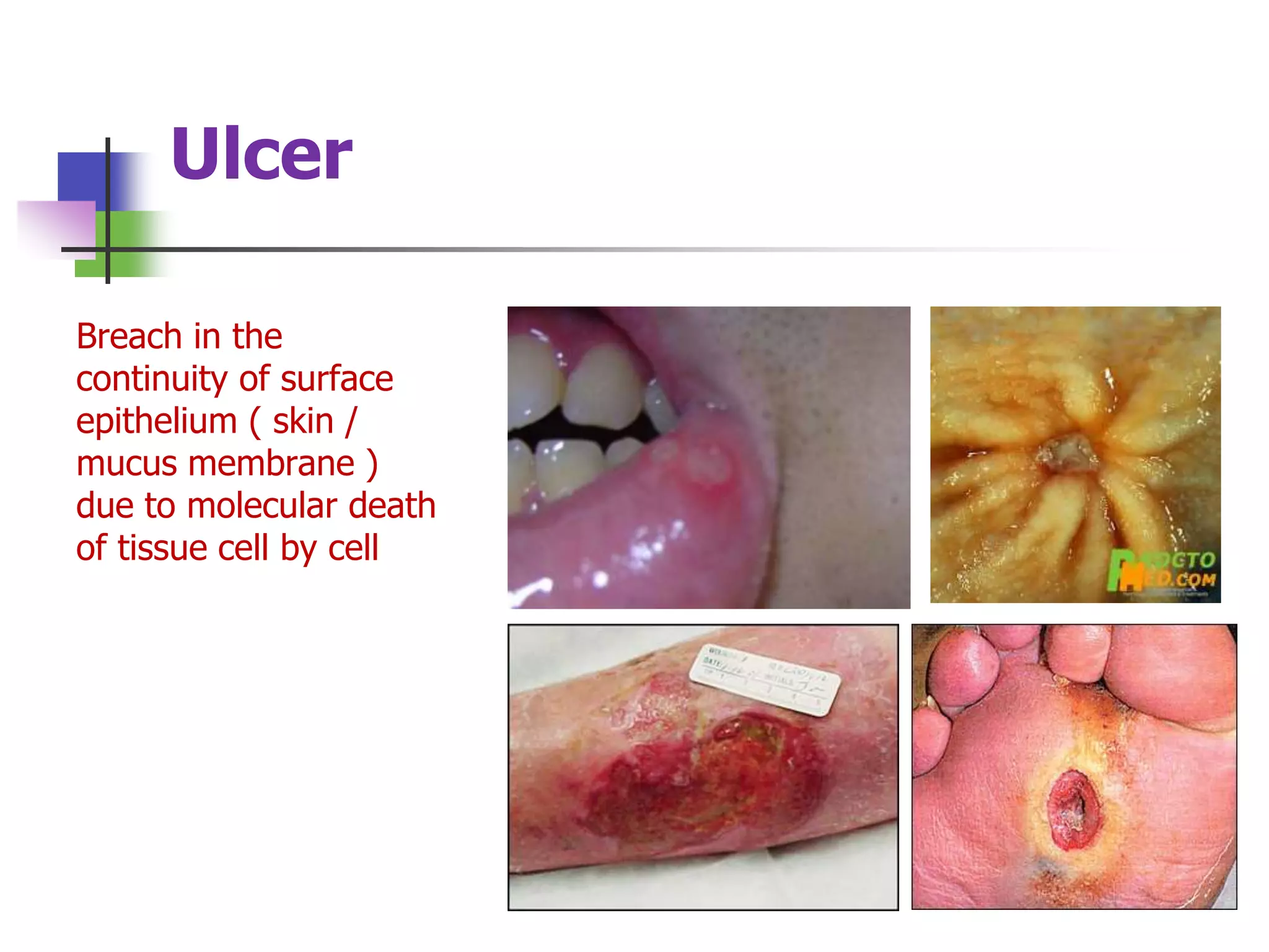 Ulcer | PPT
