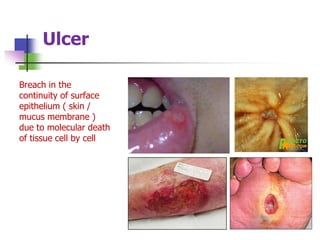 Ulcer | PPTX