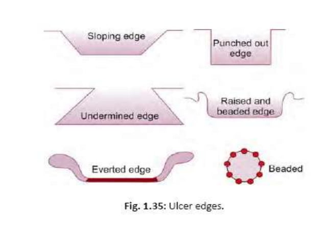 Ulcer | PPTX | Death, Injury, or Military Conflict | Sensitive Topics