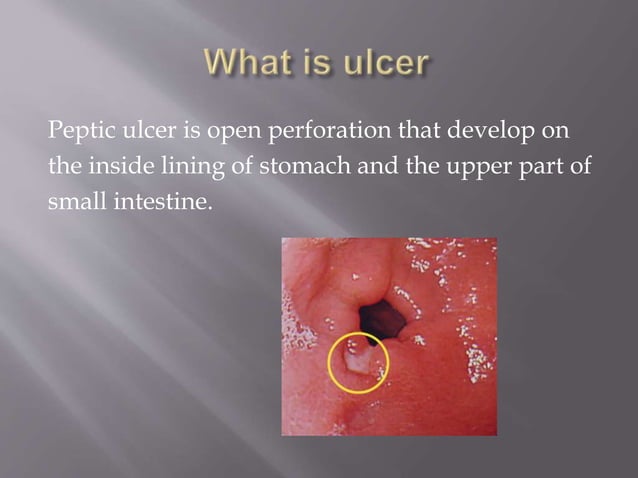 Ulcer | PPT | Free download