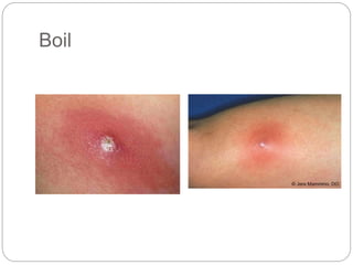 Ulcer | PPTX
