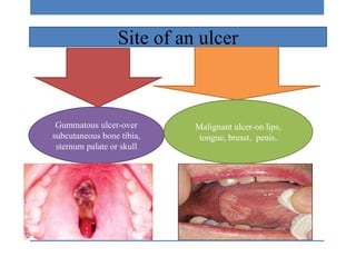 Ulcer | PPT