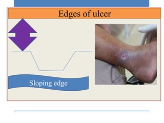 Ulcer | PPT
