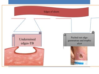 Ulcer | PPT