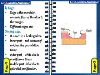 Ulcer by Dr. AmrithaAnilkumar | PPT