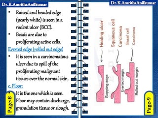 Ulcer by Dr. AmrithaAnilkumar | PPTX